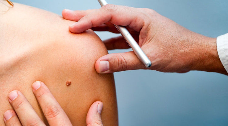 The A B C D E of skin checking Solbari USA